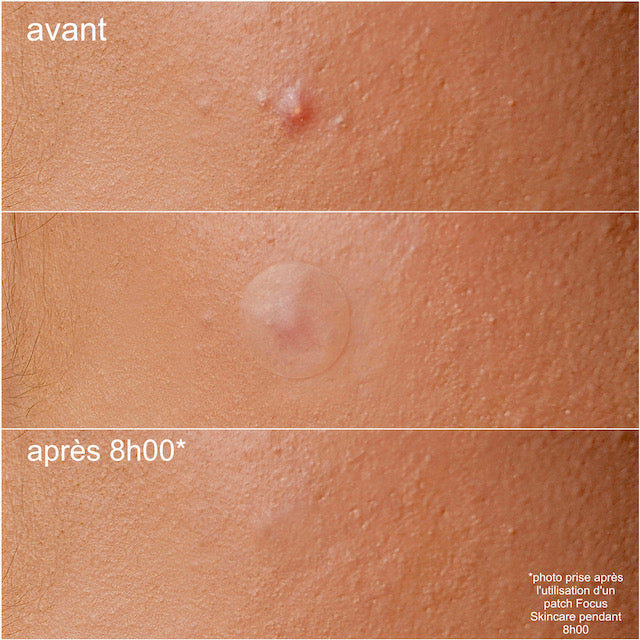 72 patchs Anti-Imperfections | FOCUS SKINCARE